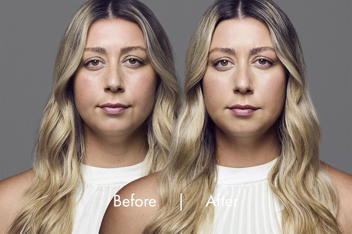 RHA Fillers in Salem, MA | uGlow Med Spa